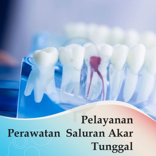 PERAWATAN SALURAN AKAR TUNGGAL - KLINIK STELLA MEDIKA 1 - Kegunaan ...